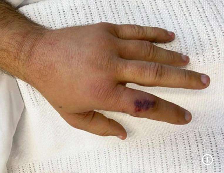 Snake Bite in Australia - Avoidance and Treatment Advice - Wildlife ...